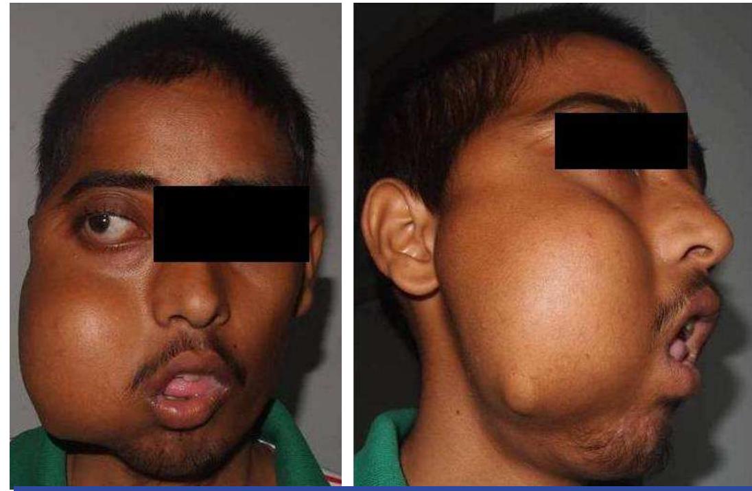 Intraorally, swelling involving right buccal mucosa, buccal