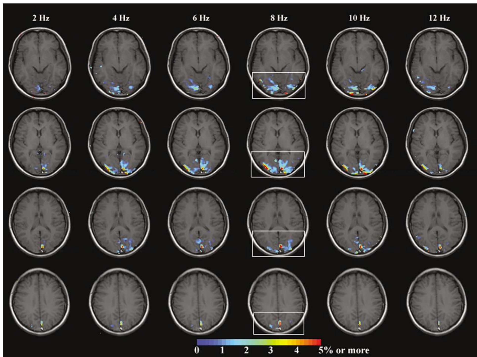 Example of activation maps superposed on 7, anatomical