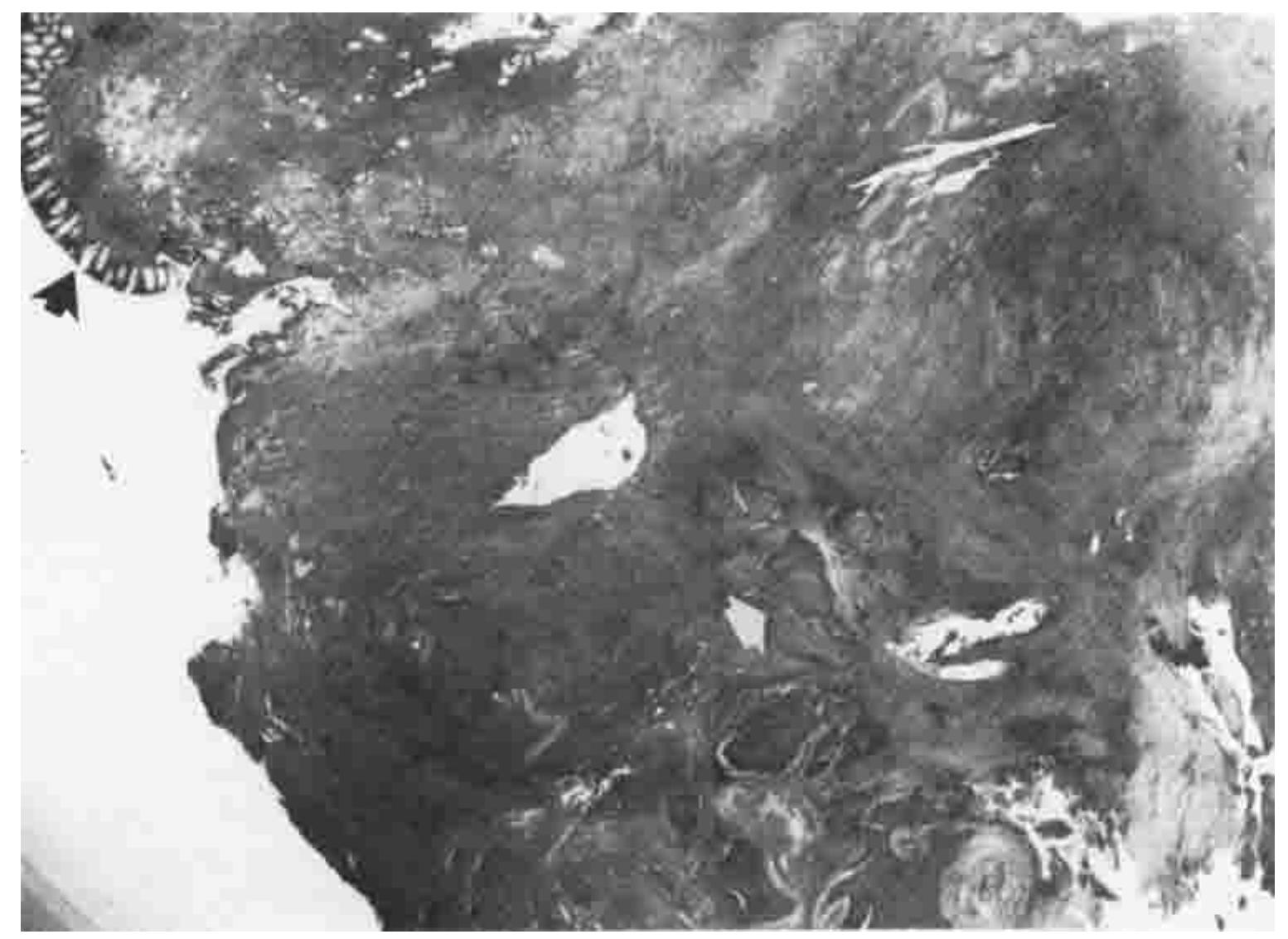 Biopsy specimen of rectal mass showing rectal mucosa (black