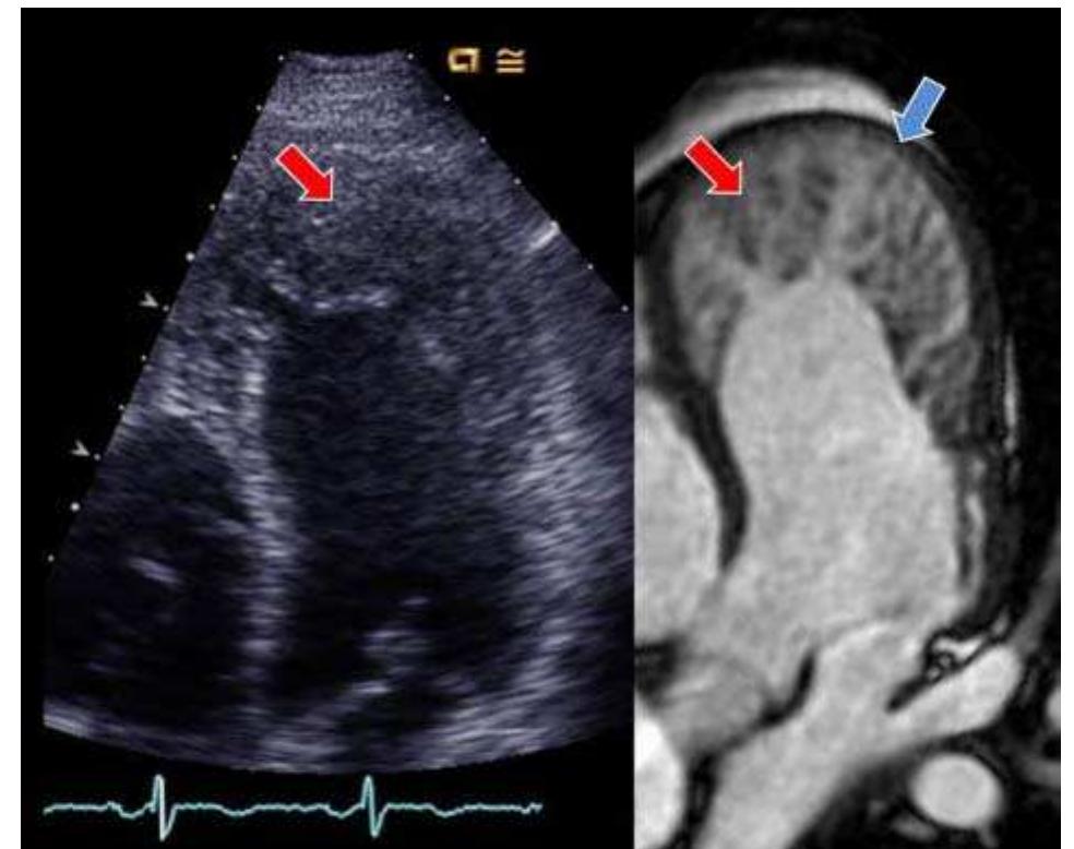Echocardiographic (left panel) and cardiac mri (right panel)