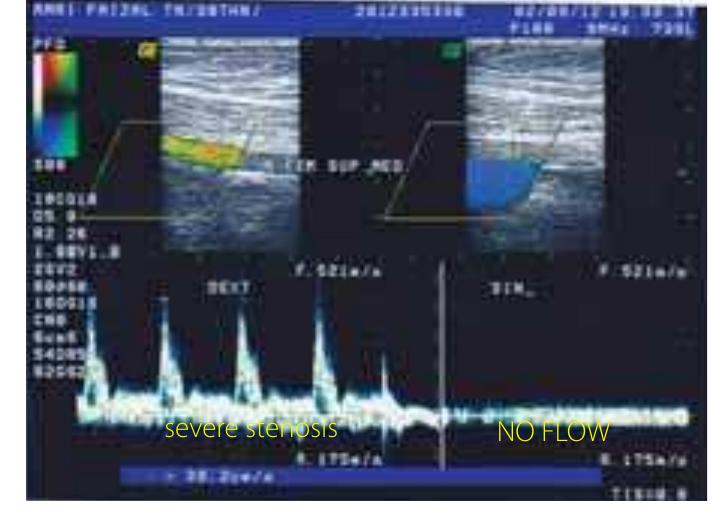 1. triphasic doppler curve morphology on aorta abdominalis