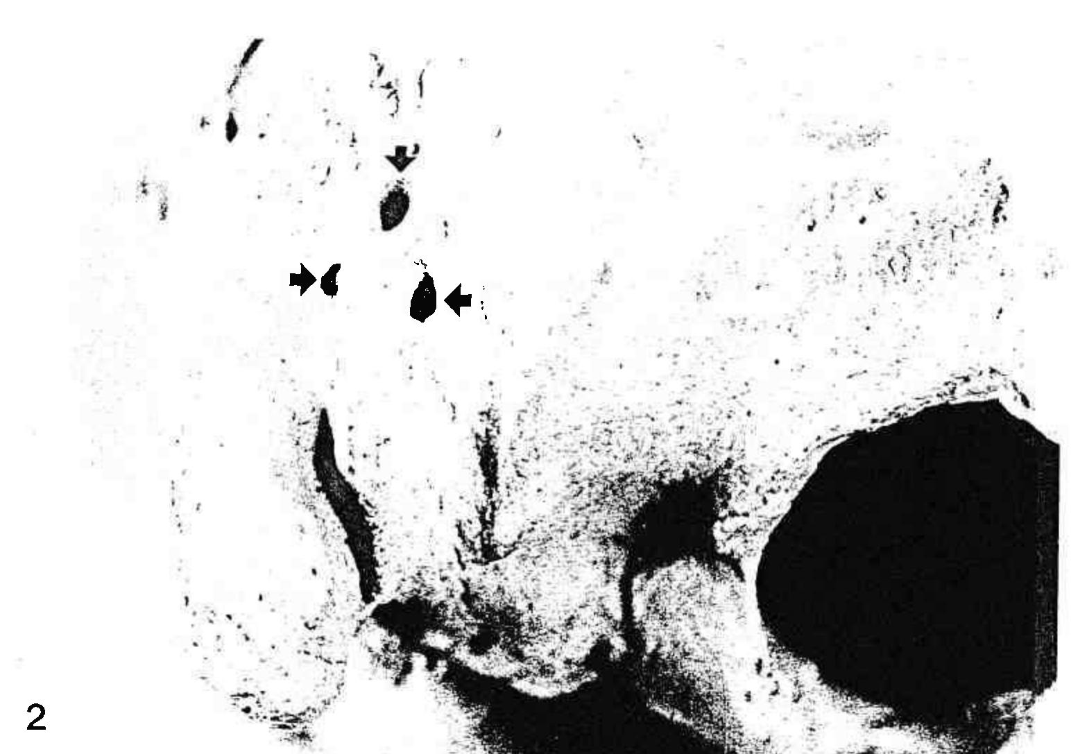Figure 2 - from The incidence and localization of mastoid