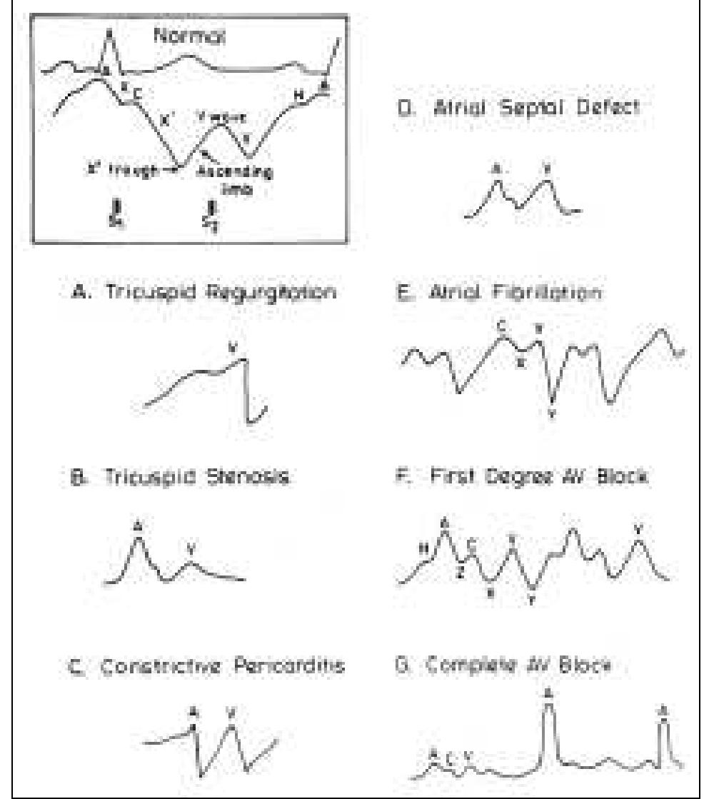 : normal and few diagnostic abnormal venous pulse wave
