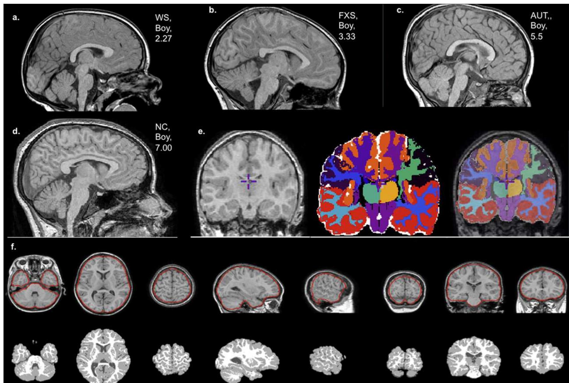 Study methodology. examples of native brain maps for (a)