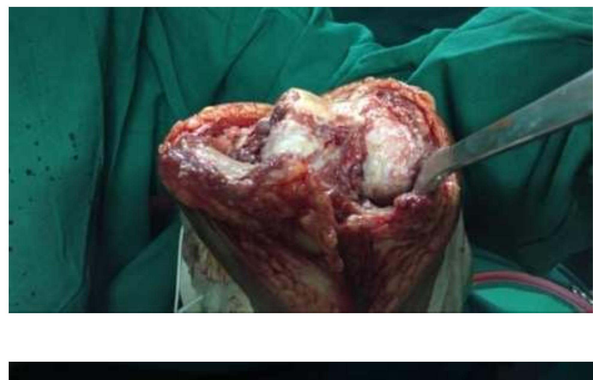 Figure 30 - Surgical approaches to the knee joint