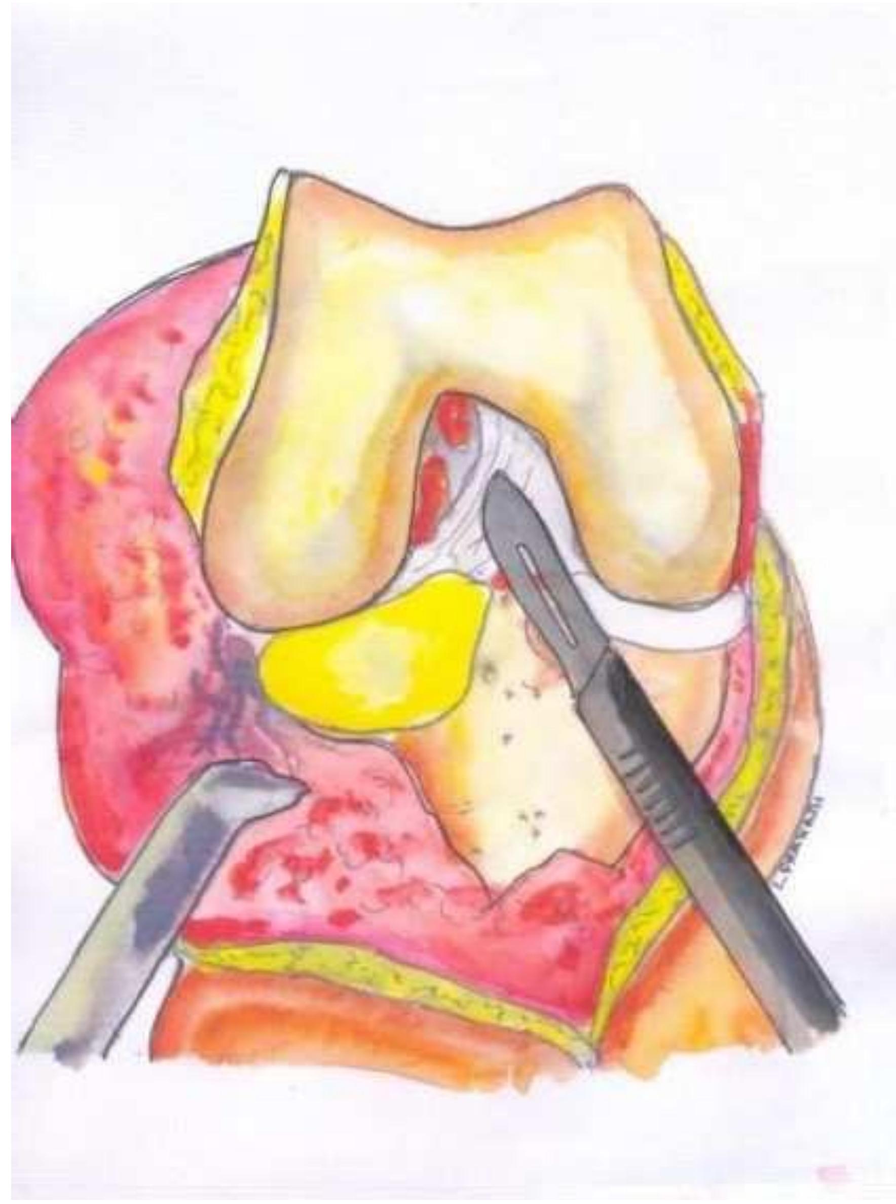 Figure 36 - Surgical approaches to the knee joint