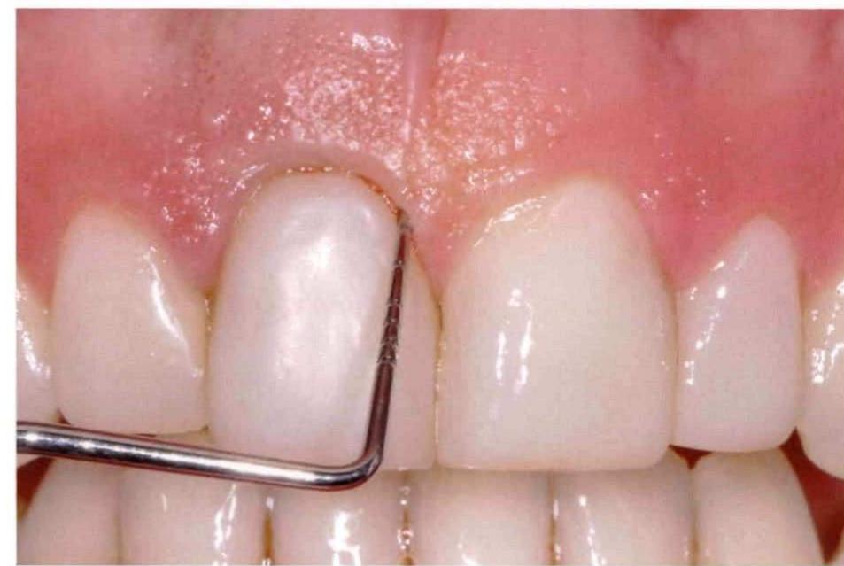 (PDF) Biologically oriented preparation technique (BOPT): a ne\A ...