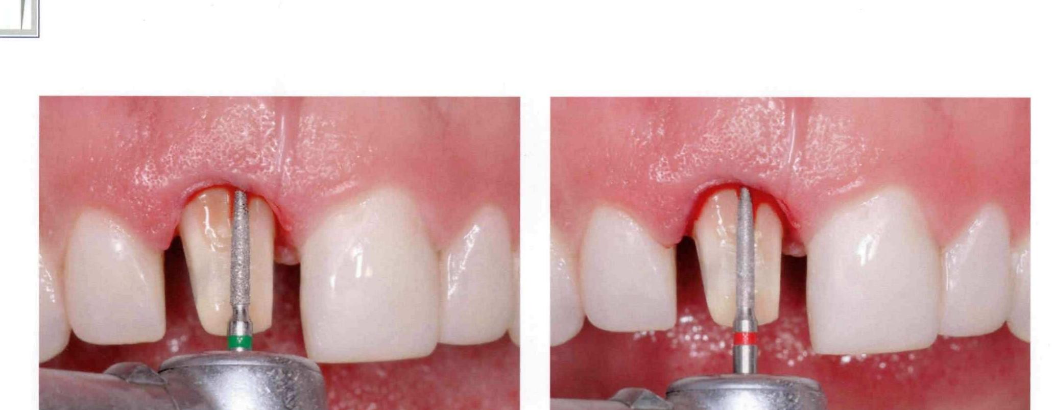 Figure 4 - Biologically oriented preparation technique