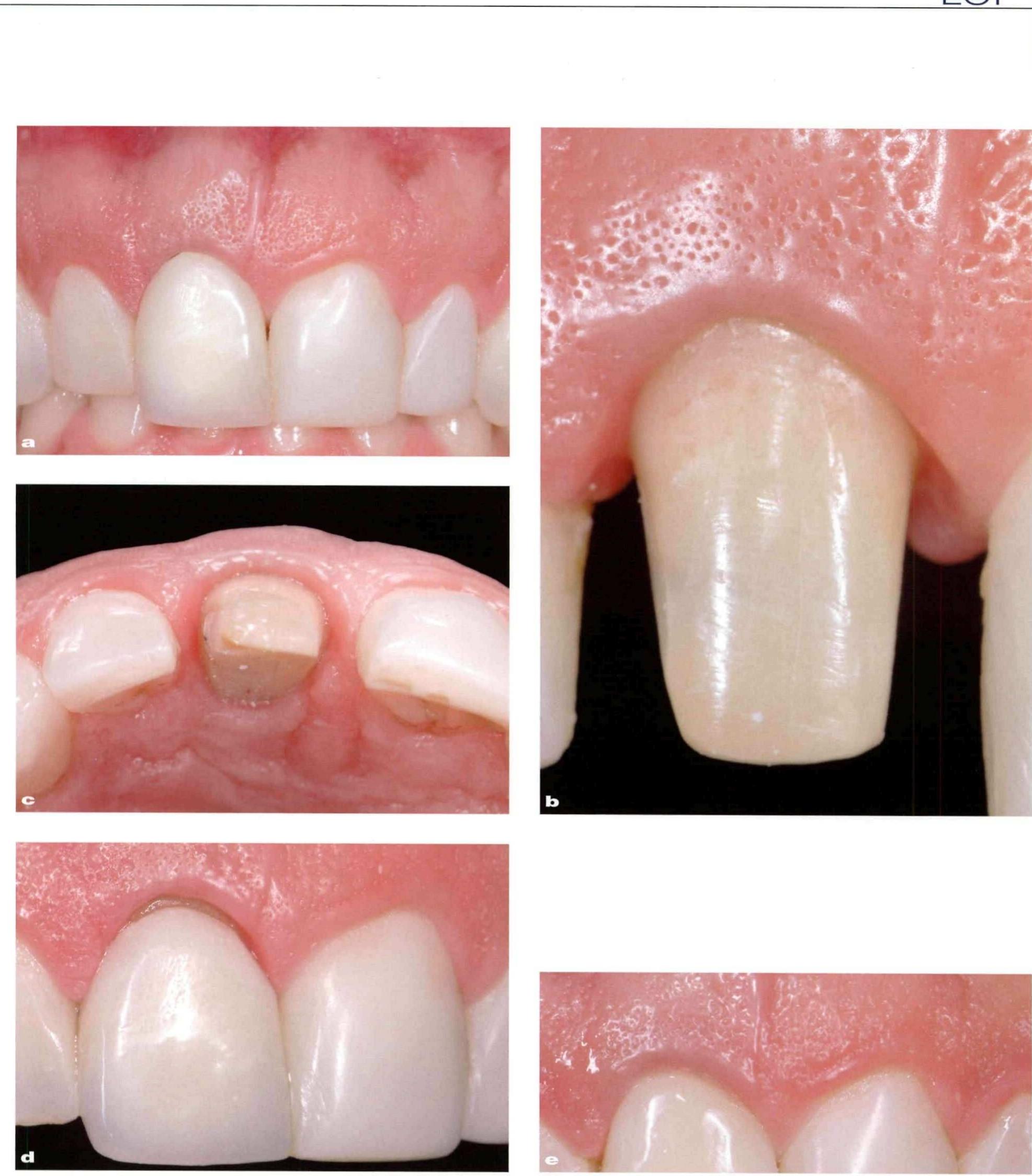 = after 4 weeks the blood clot, protected by the crown’'s