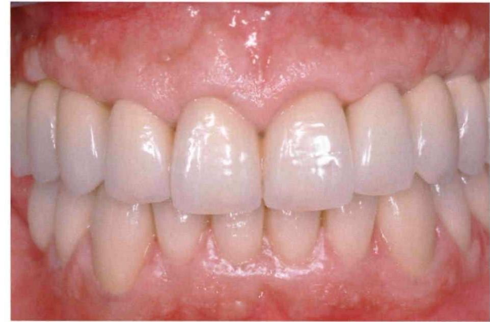 Clinical aspect of the finished case.