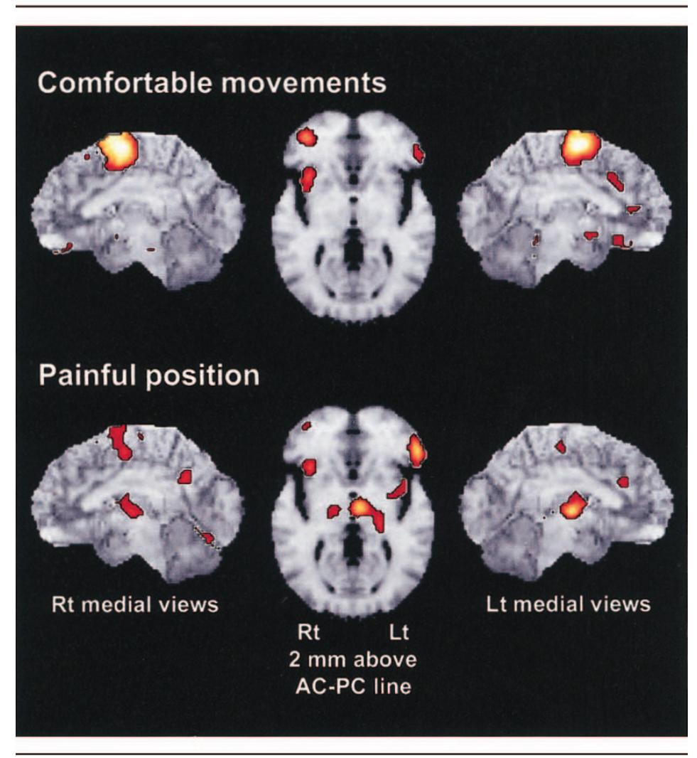 Figure 4 - Phantom limb pain in the human brain: unraveling
