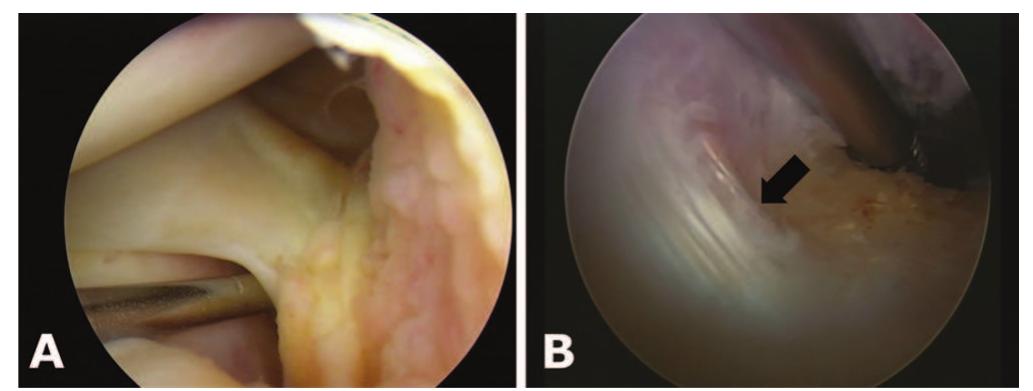 (a) arthroscopic anatomy of the medial meniscus posterior