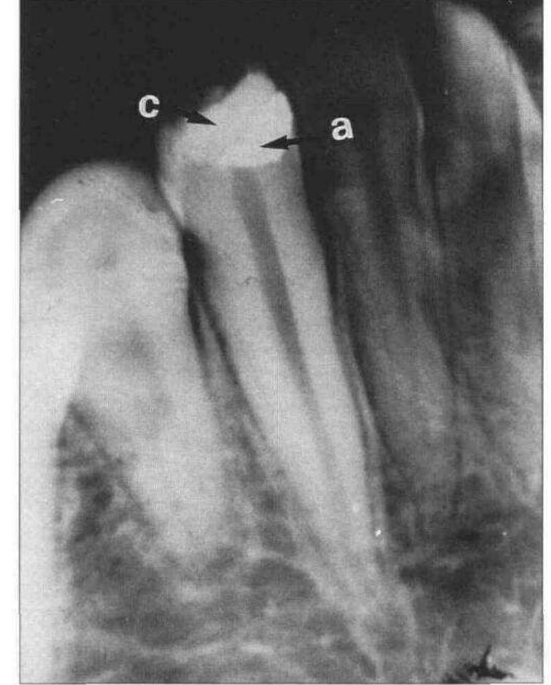 Periapical radiograph showing a combined composite (c) and