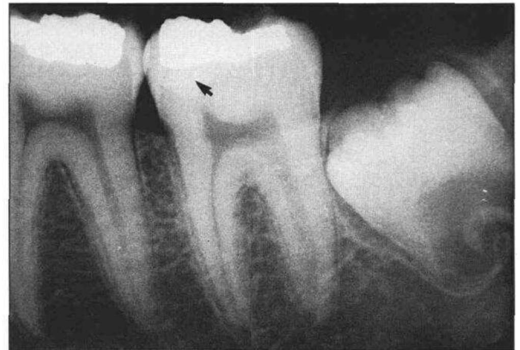 Periapical radiograph of the second mandibular permanent