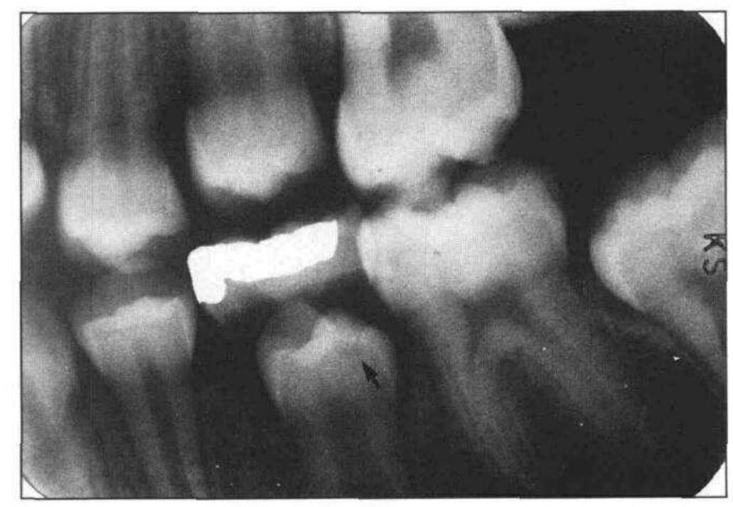 Bite-wing radiograph showing the lower left second premolar