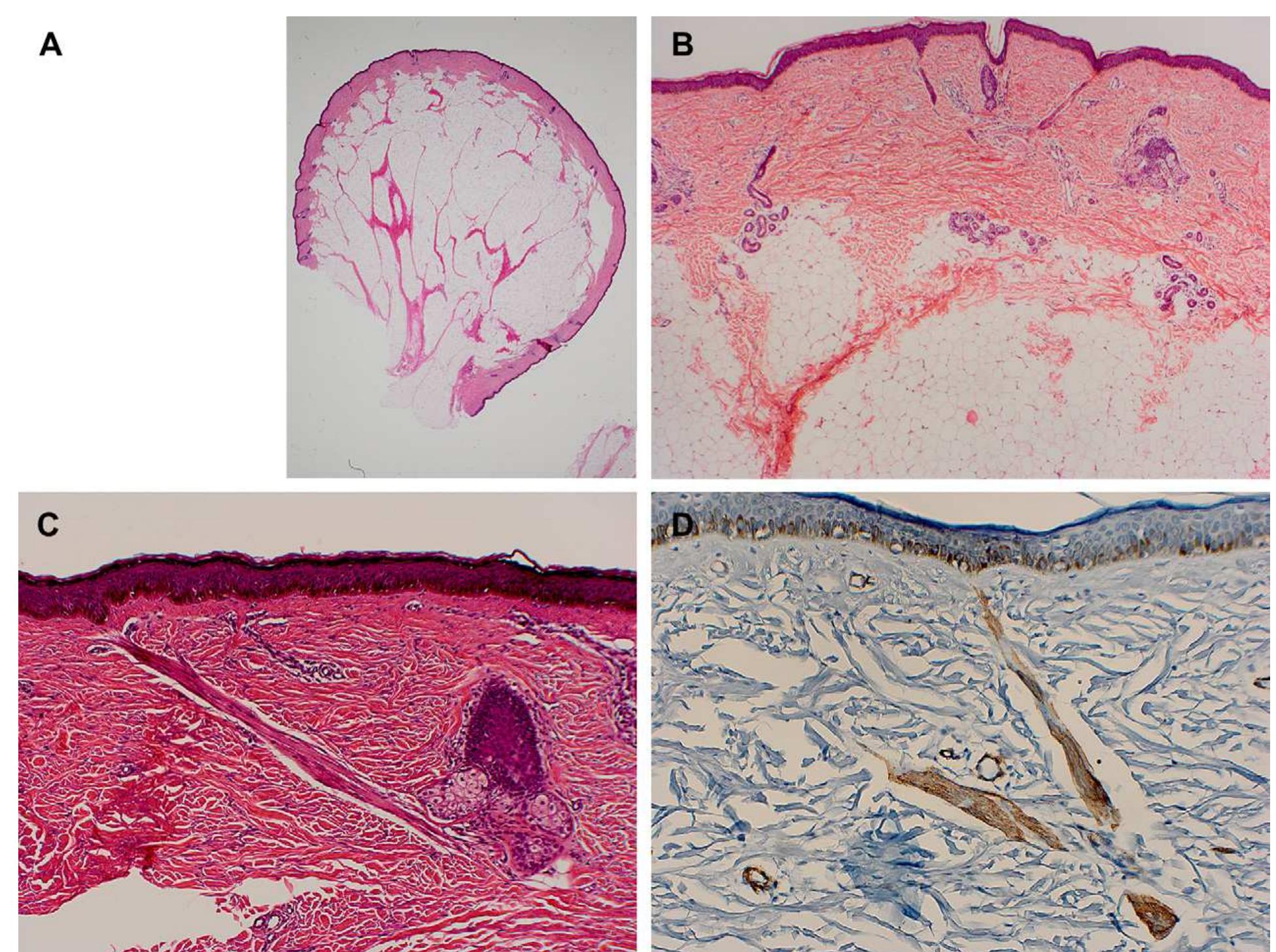 A: apical lobe of polypoidal lesion displays an outer rim