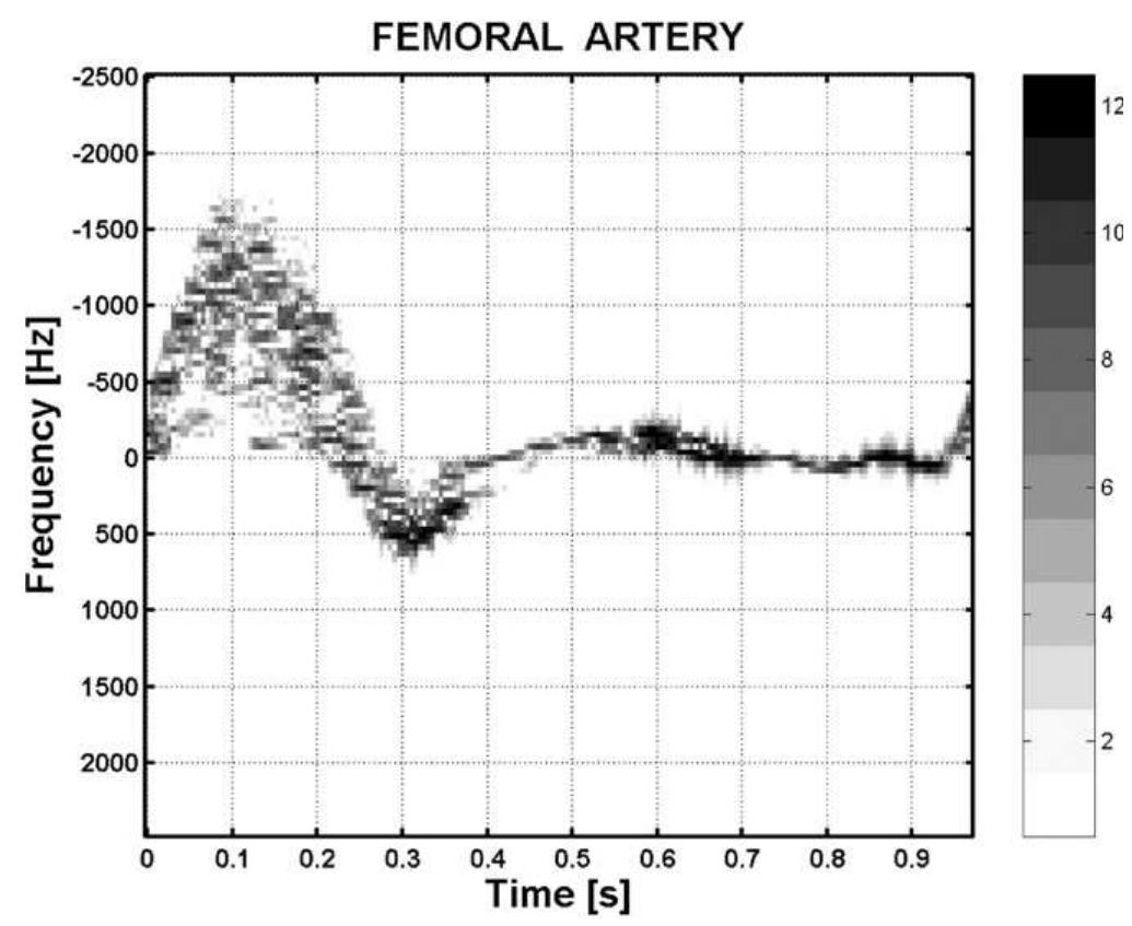 Spectrogram of a segment of a blood flow cardiac cycle from