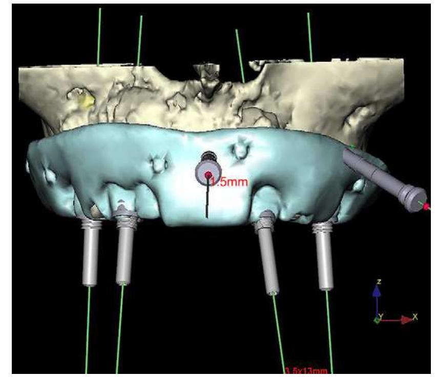 Virtual treatment plan. some of the most complex restorative
