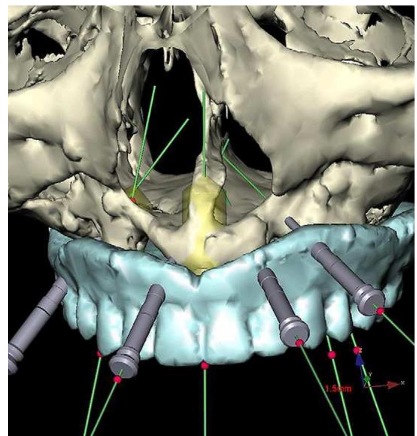 Virtual treatment plan, for the case shown in fig. 41,