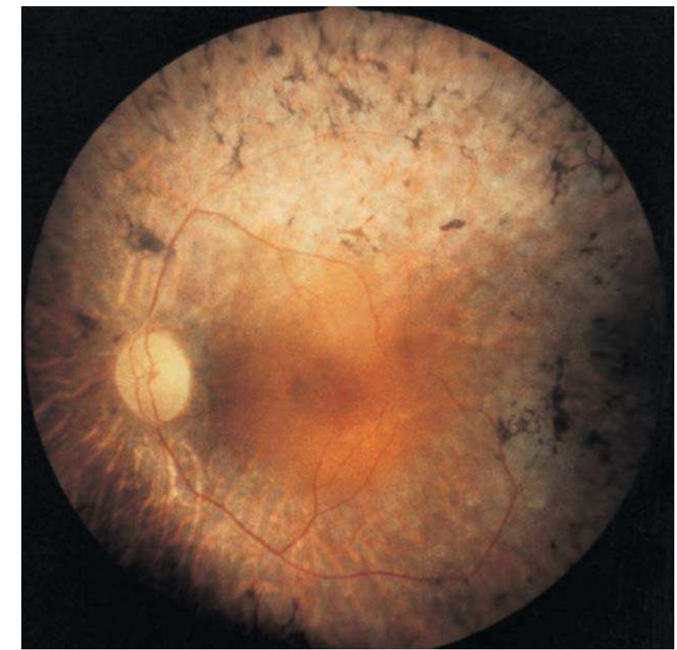 Bone spicule formation and vessel attenuation in autosomal