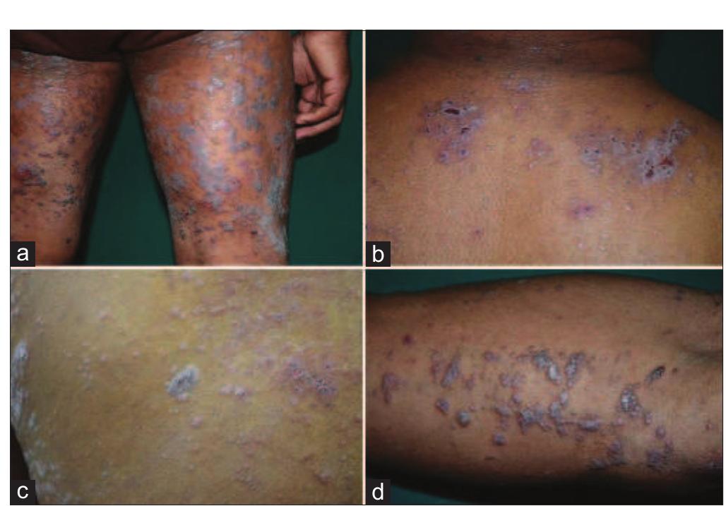 Figure 3 - from Bullous lichen planus