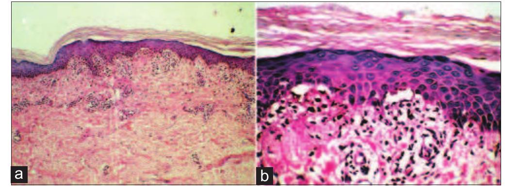 Figure 3 - from Bullous lichen planus
