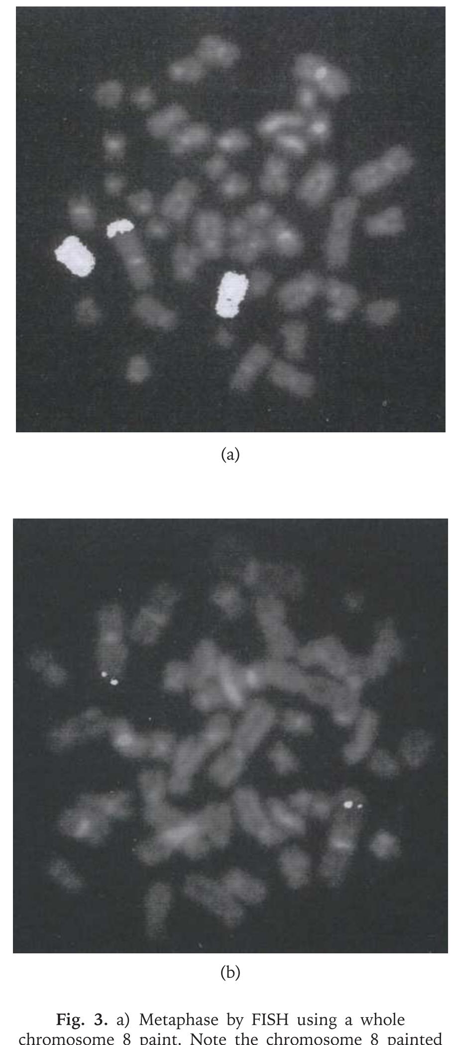 Figure 3 - Trisomy of 8q22. 3∼ q23-qter following an