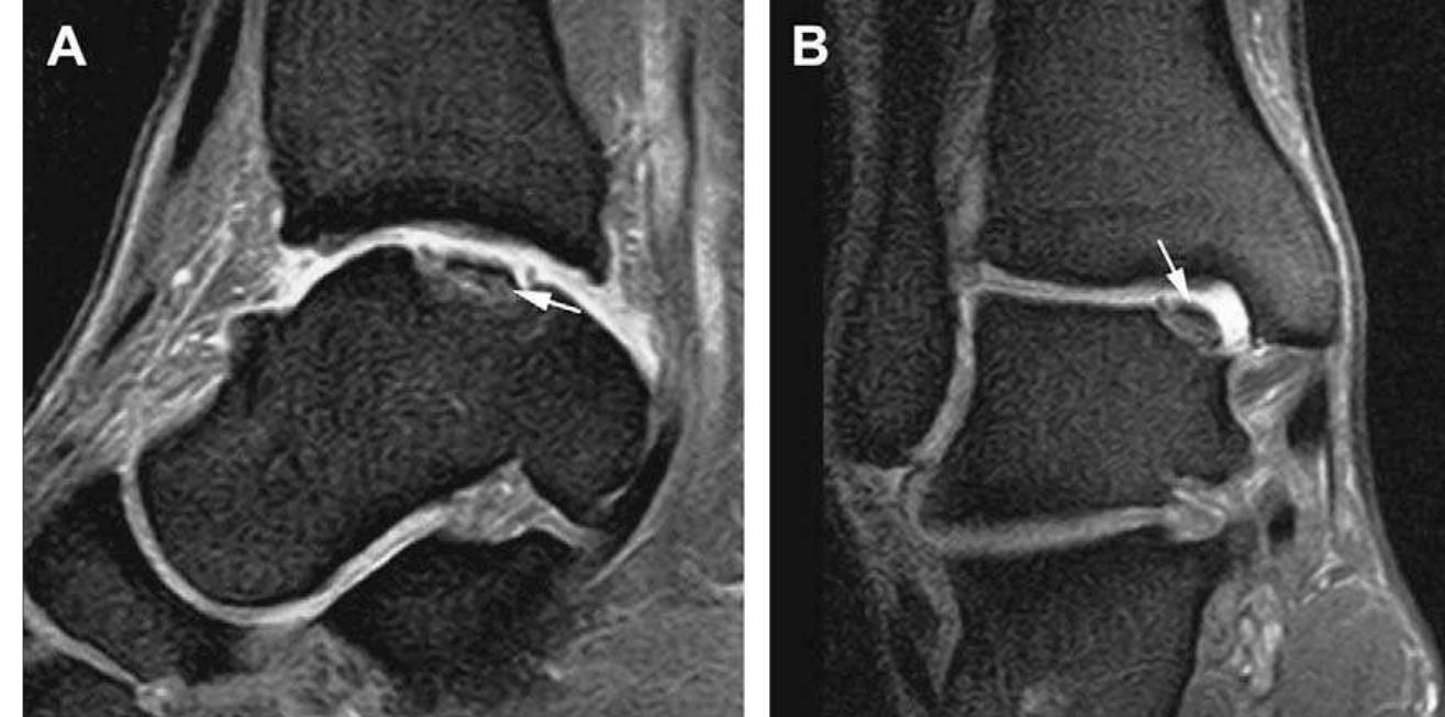 Stage ill osteochondral lesion of the talus. (a, b) sagittal