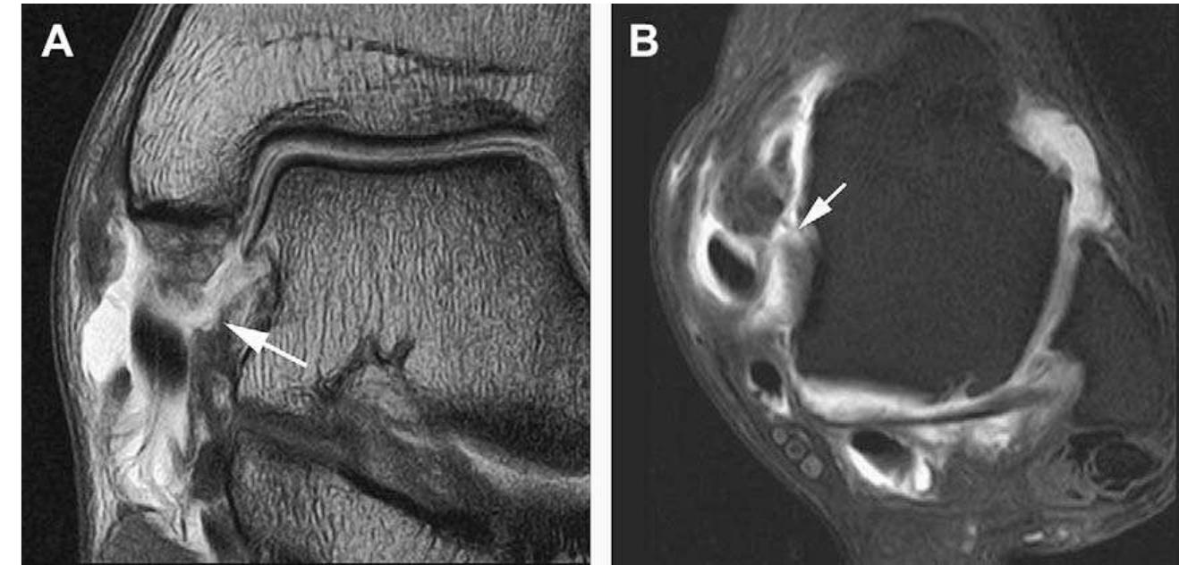 Chronic complete tear of the deltoid ligament. (a) coronal