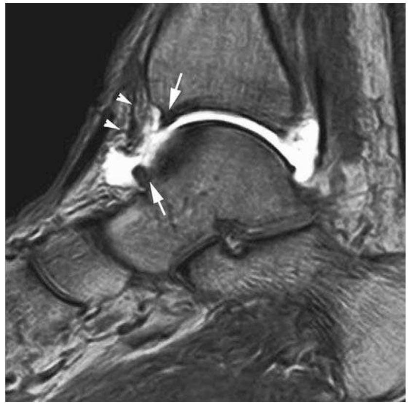 Anterior impingement syndrome. sagittal t1- weighted spin