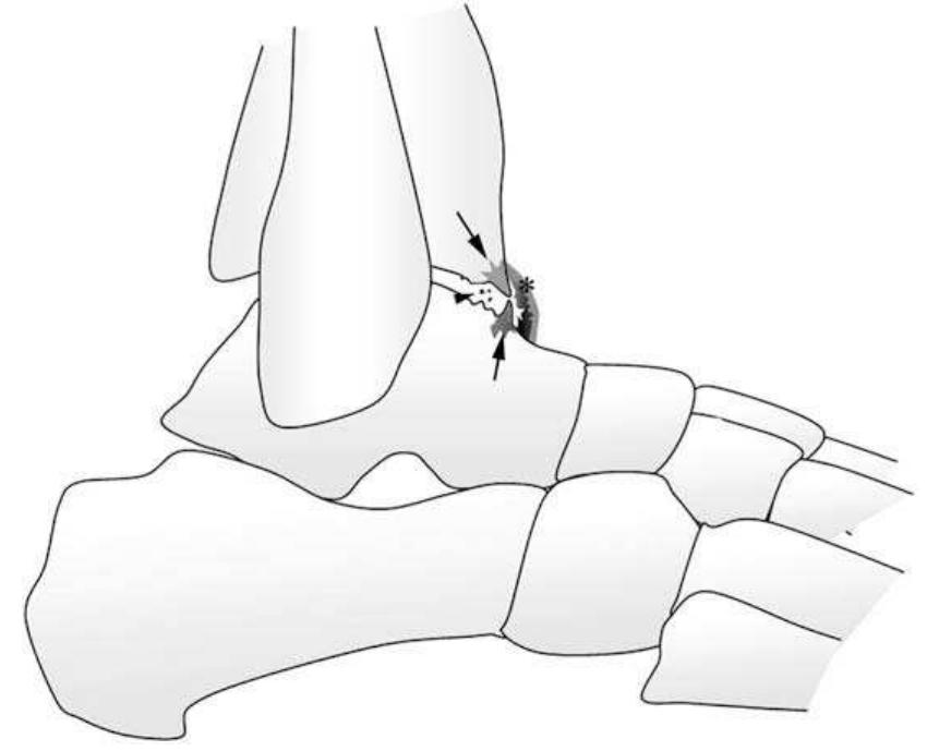 Anterior impingement syndrome. diagram shows typical