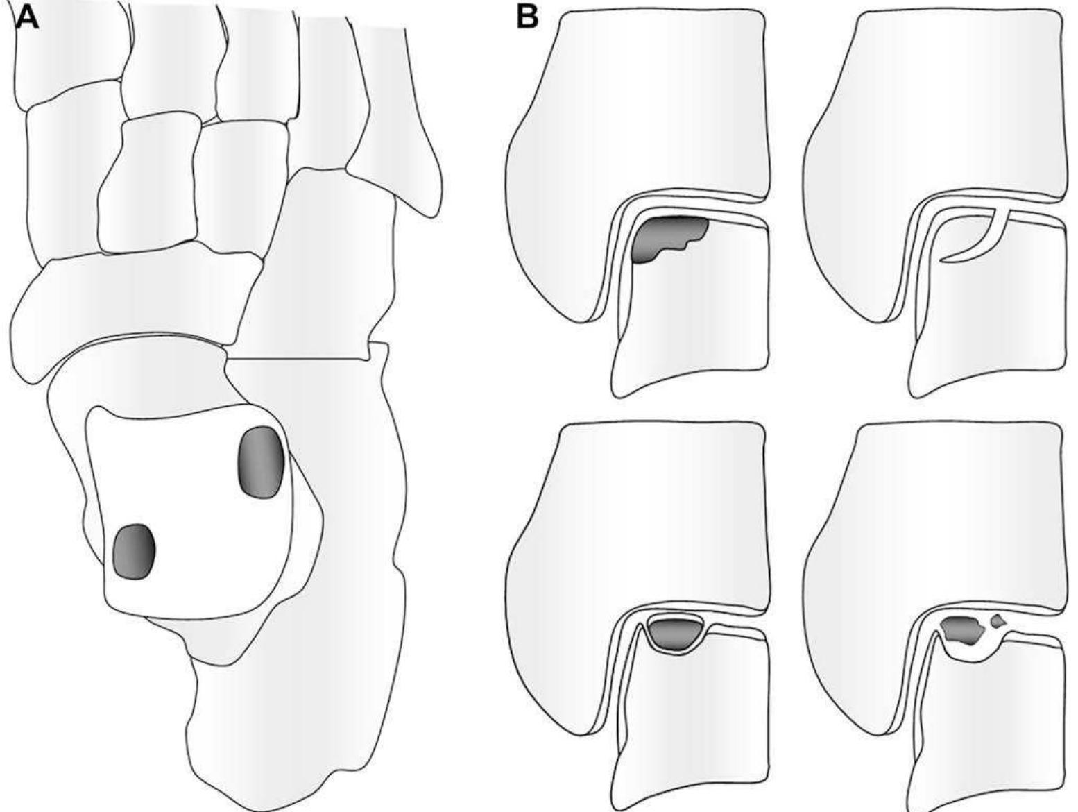 Osteochondral lesions of the talus. (a) the main locations