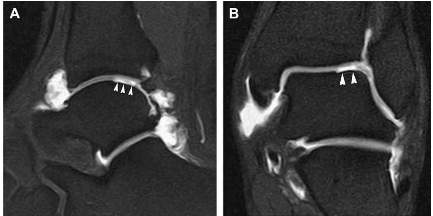 Chondral grade iv lesion of the talar dome. (a, b) sagittal