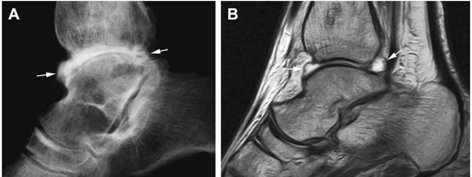 Adhesive capsulitis of tibiotalar joint. (a) lateral ankle