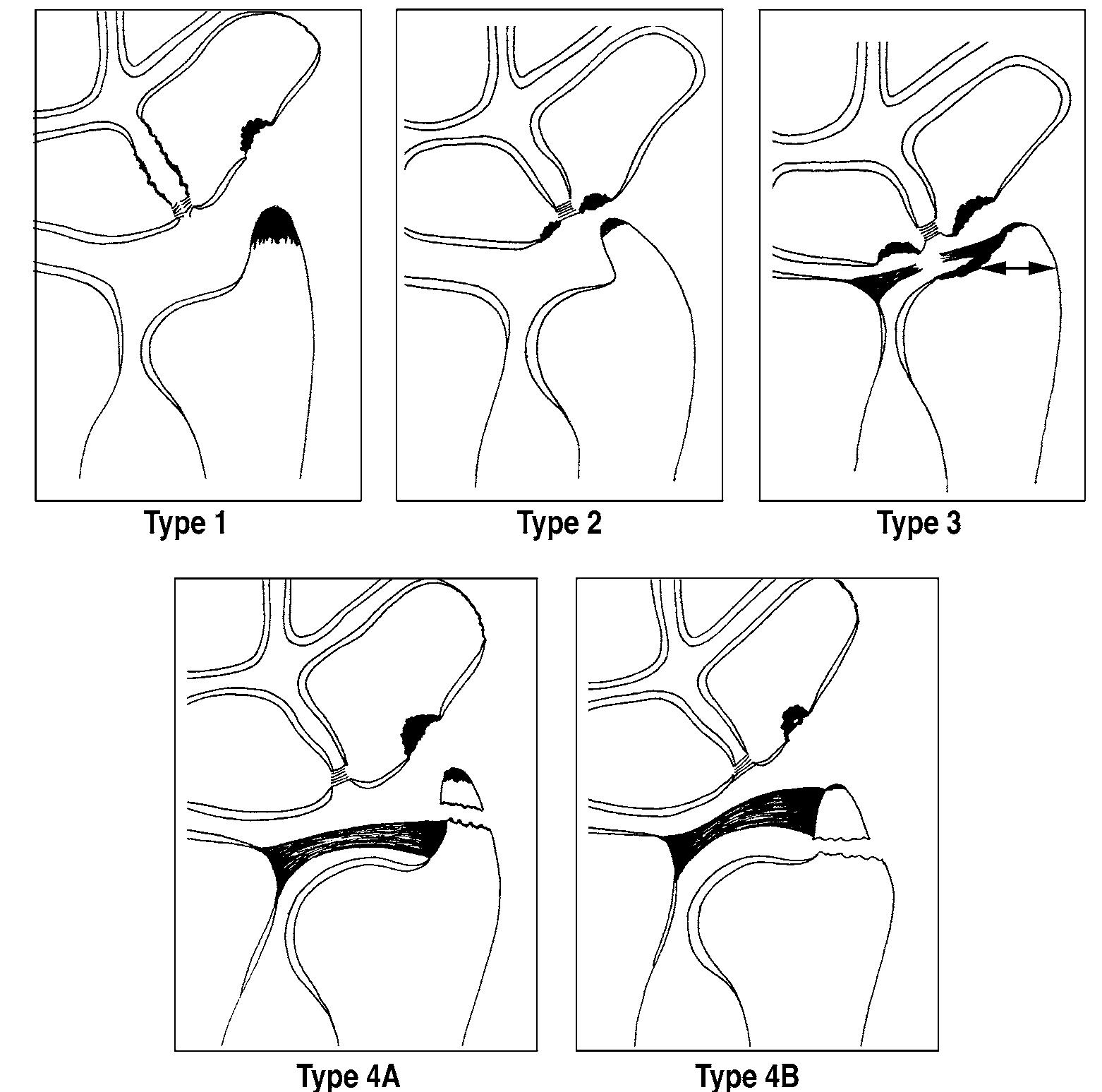 Classification of ulnar styloid (us) impaction syndromes.