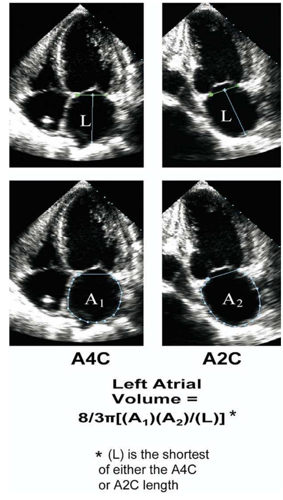 Measurement of left atrial (la) volume from area-length (z)