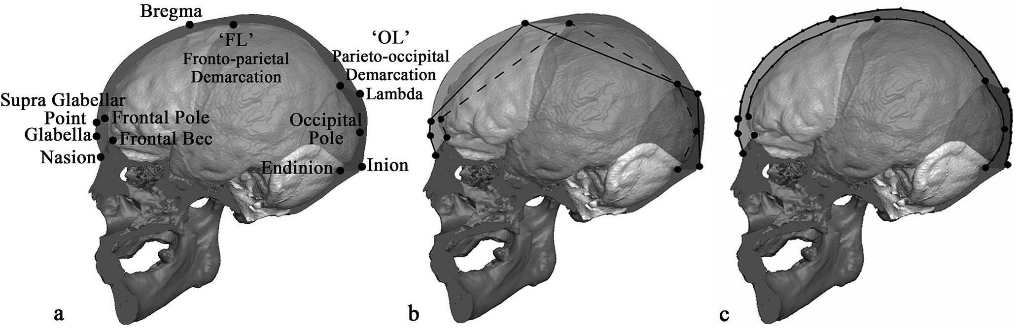 A: mid-sagittal plane with fixed landmarks used in this