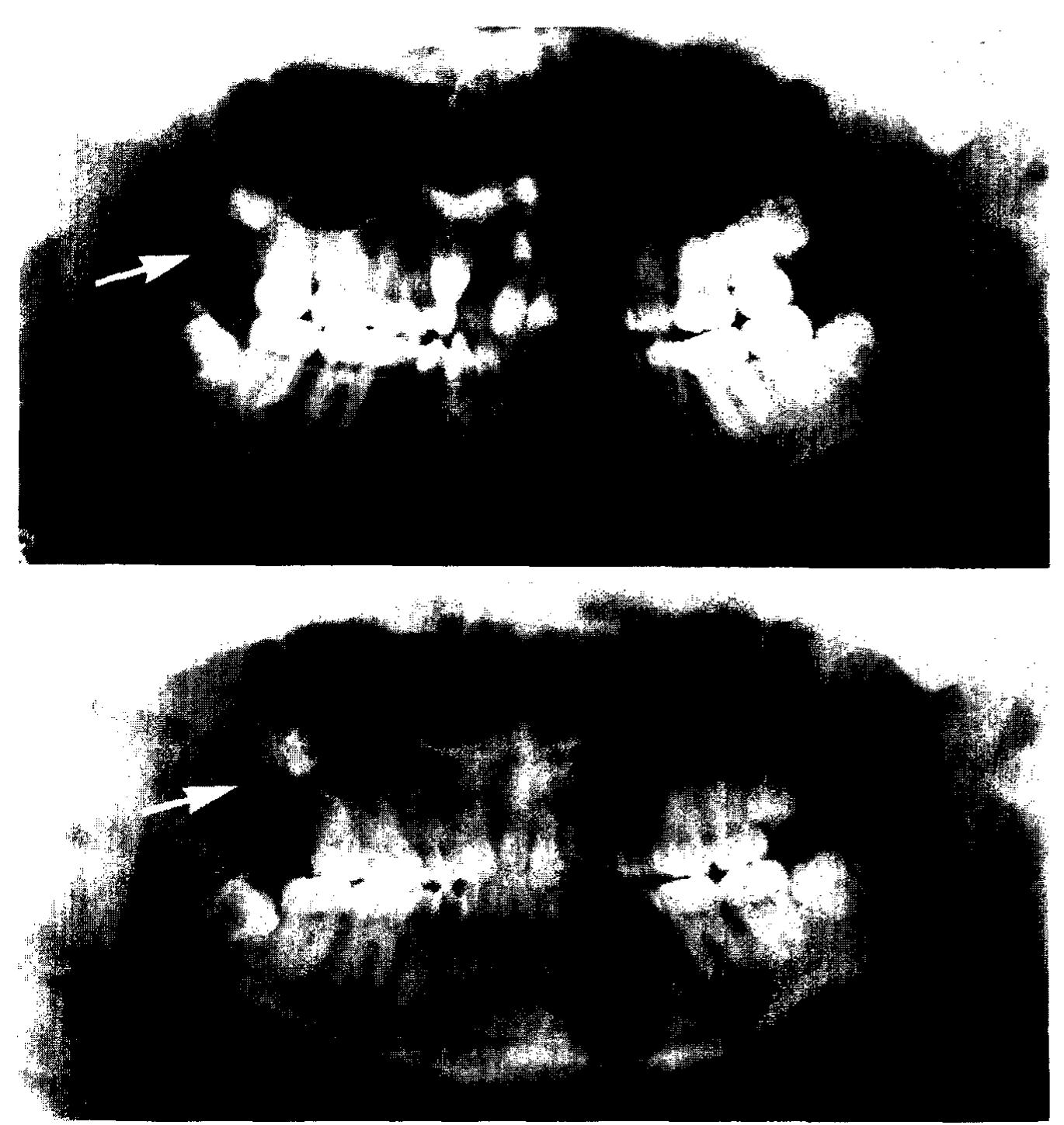 Approach to the posterior osteotomy and reviewed all aspects