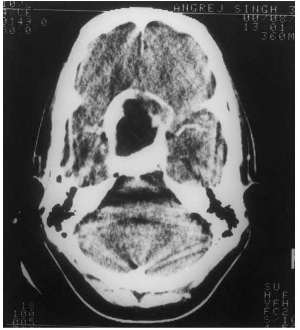 Contrast-enhanced ct scan of the head (axial view) showing a