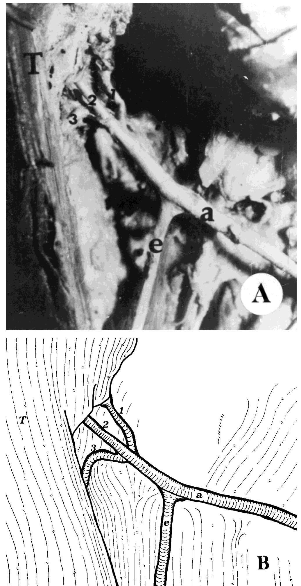 A: right tensor fasciae latae muscle (t) supplied from the