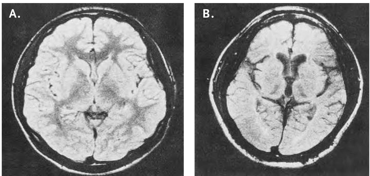 Brain atrophy in a toulene abuser compared with the brain of
