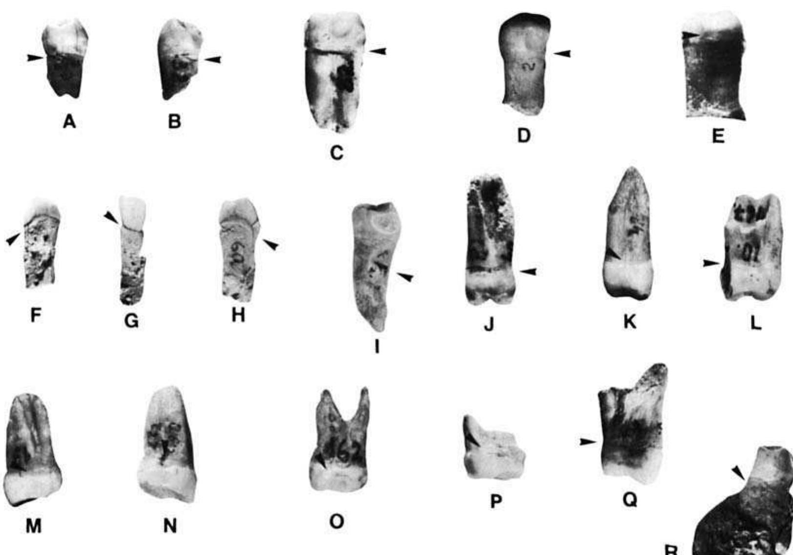 Distal of 172. o: mesial of 162. p: mesial of 175. q: mesial