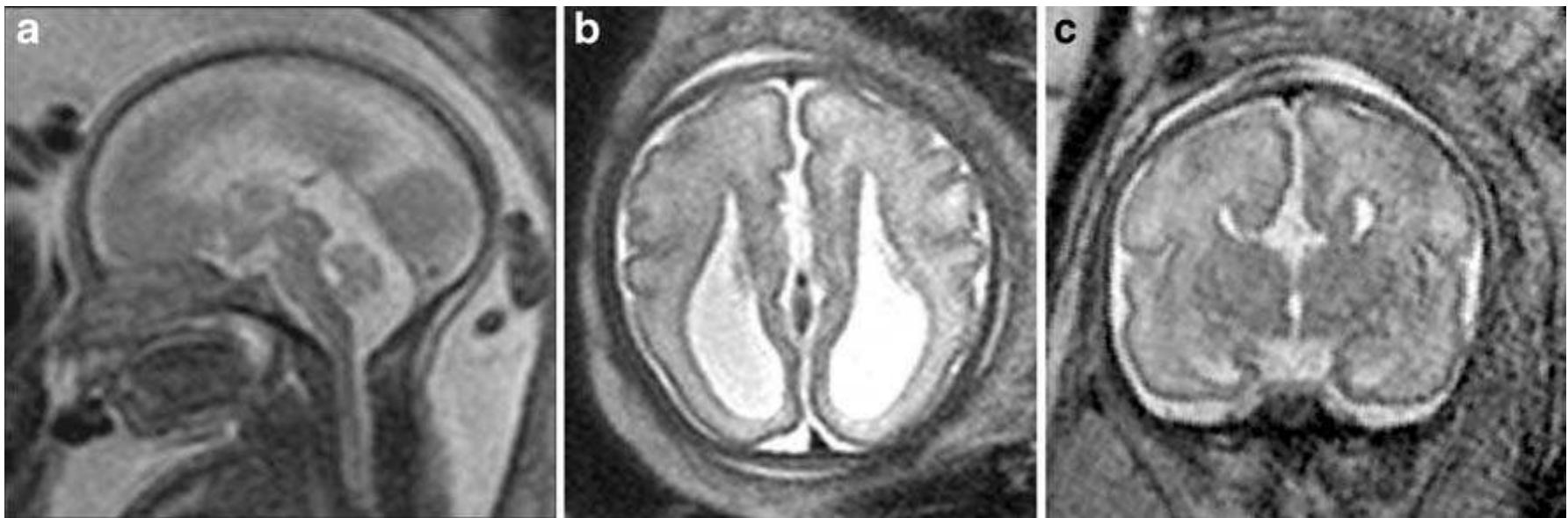 Agenesis of the corpus callosum. sagittal (a), axial (b) and