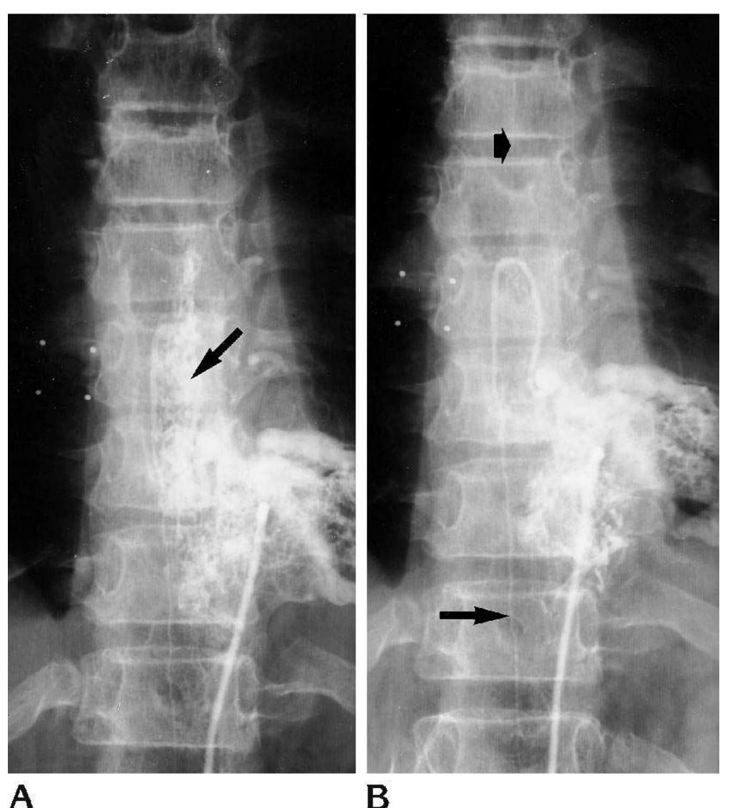 Spinal cord arteriovenous malformation (avm) in a