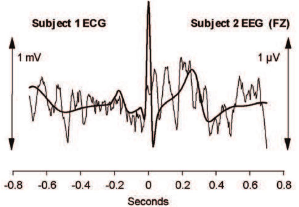 6. overlay of signal-averaged eeg and ecg. this graph is an