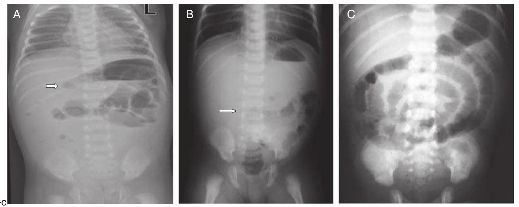 (a) non-contrasted x-ray of the abdomen: distended abdomen,