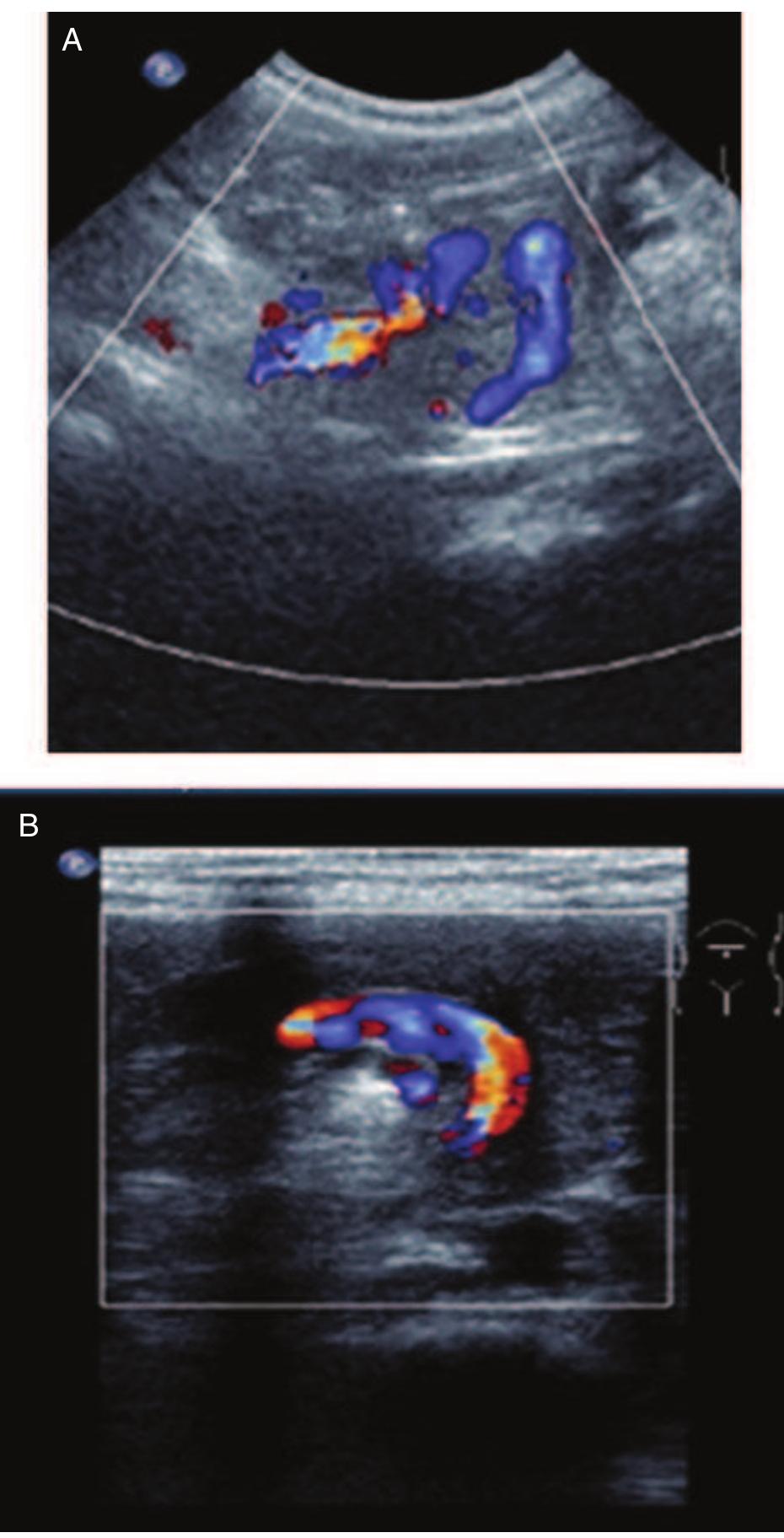 Ultrasonography in the presence of volvulus: note the “whirl