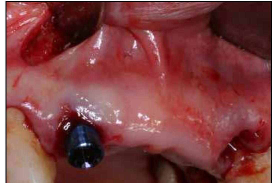 A pain radiograph reveals severe alveolar bone resorption in
