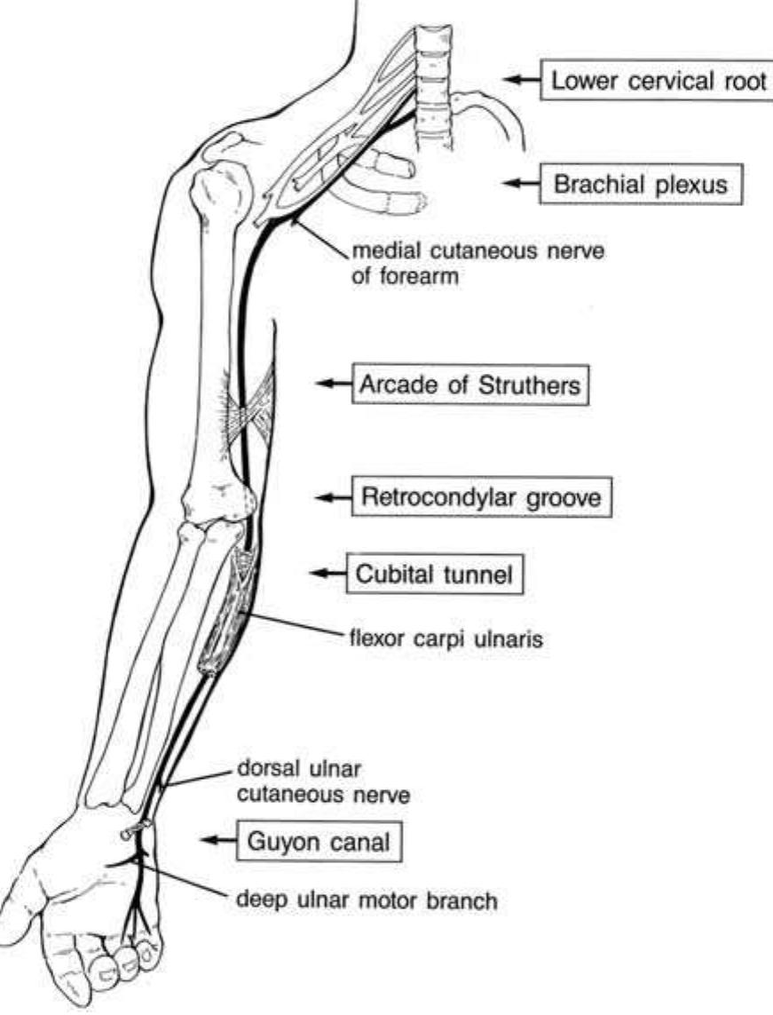 1 sites of entrapment for the median nerve carpal tunnel