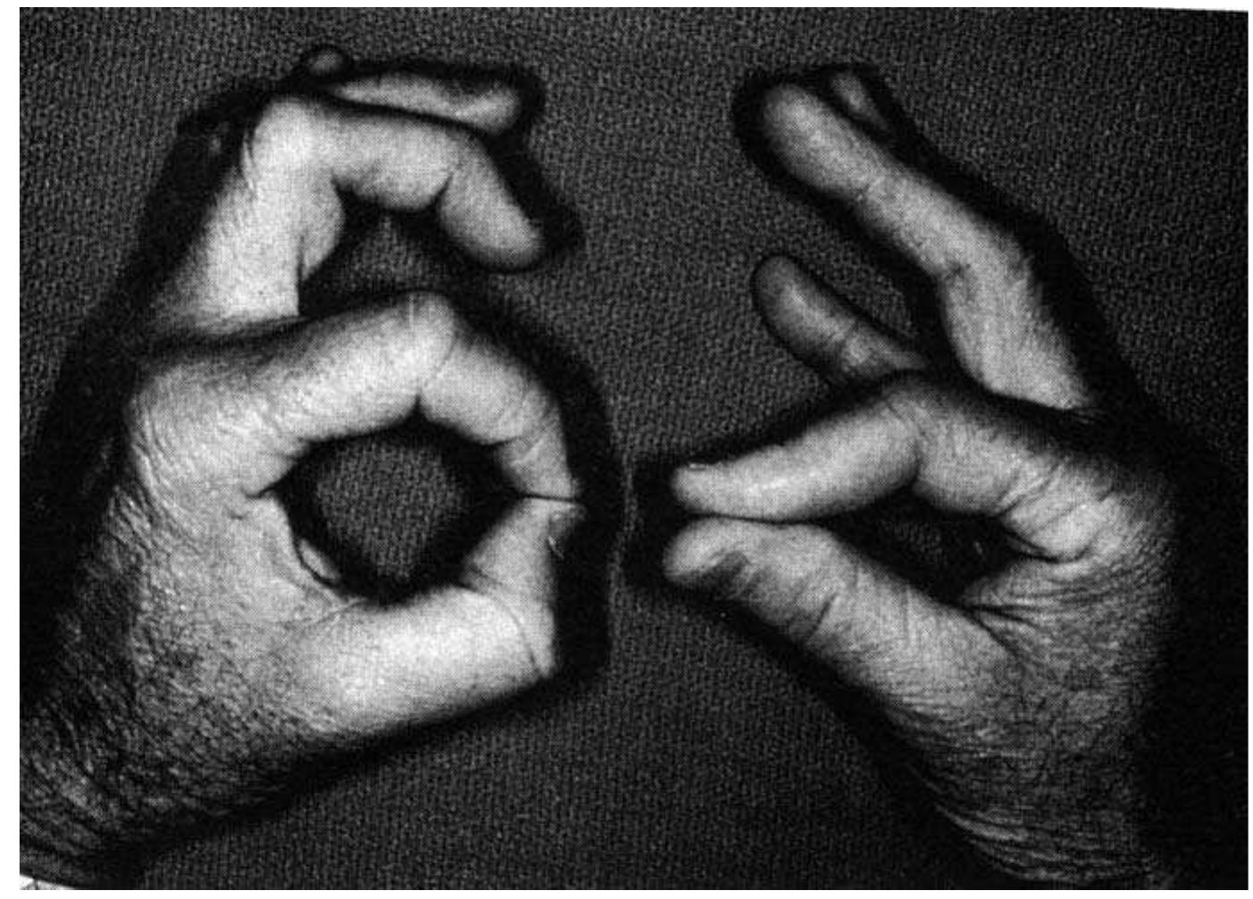 2 typical pinch sign with flattening of index pulp and